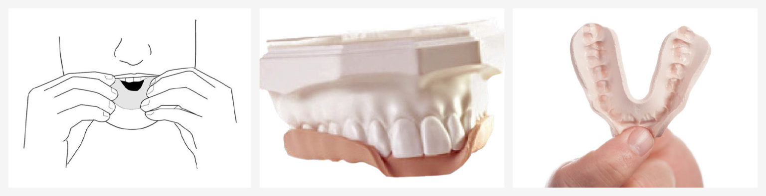 AM Aligner Prevents Bite Change and Tooth Movement | New West
