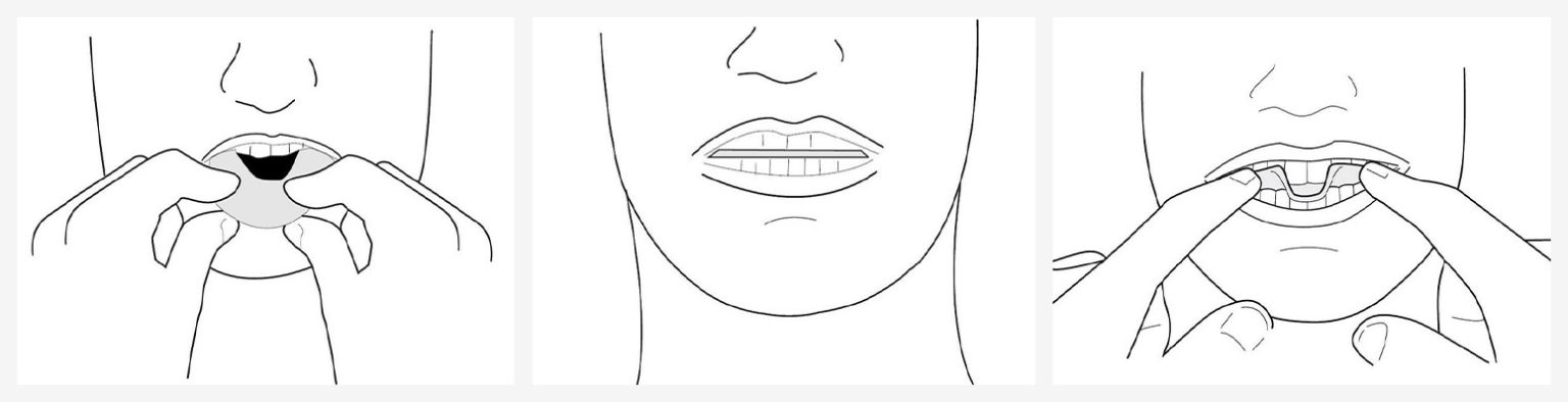 AM Aligner Prevents Bite Change and Tooth Movement | New West