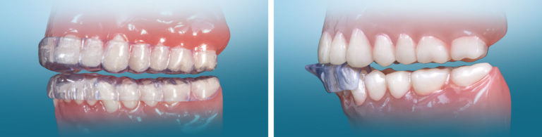 How Are Migraines and Jaw Pain Connected? | New West