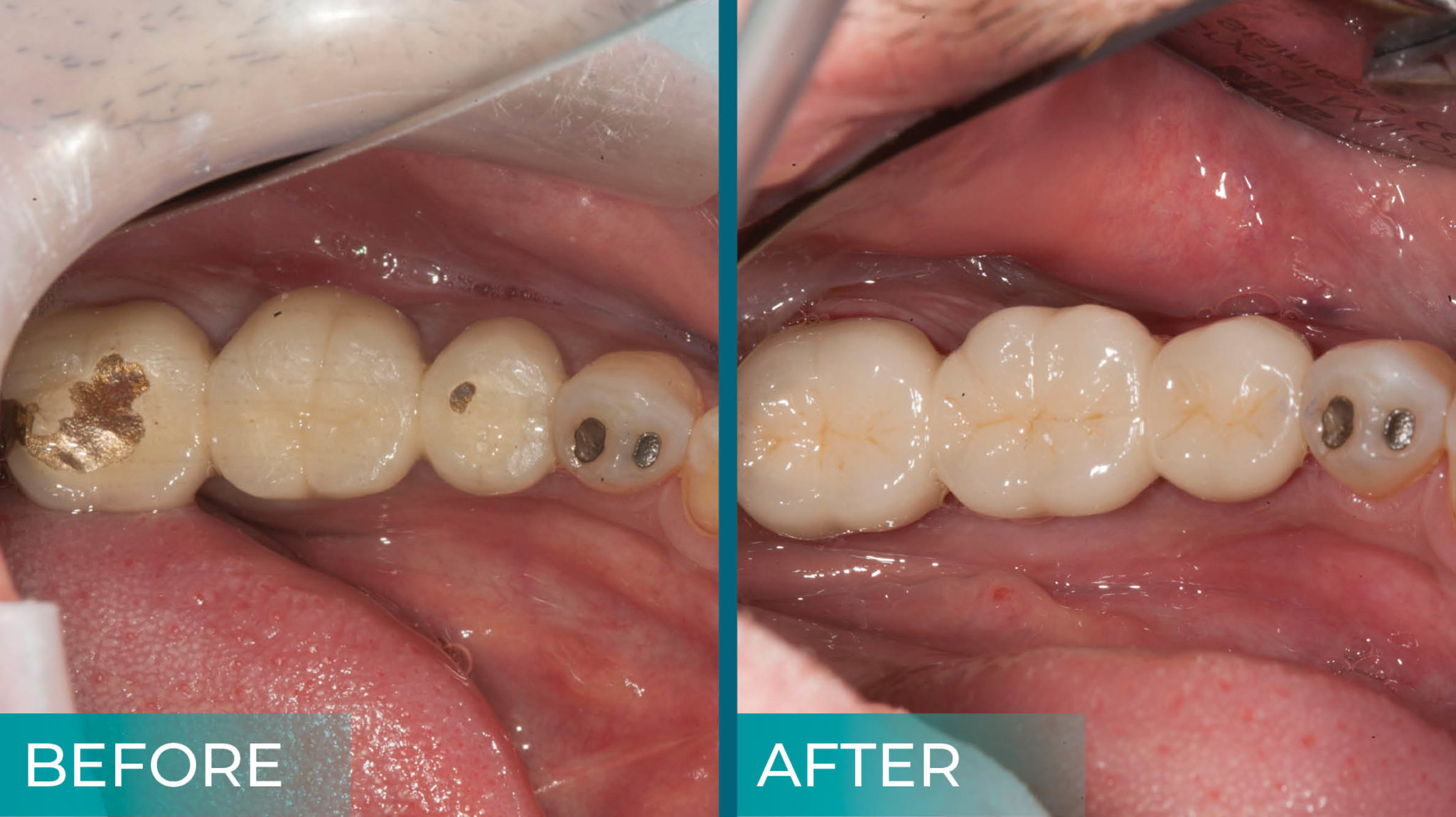 Zirconia Versus PFMs: Which Should You Crown the Winner?