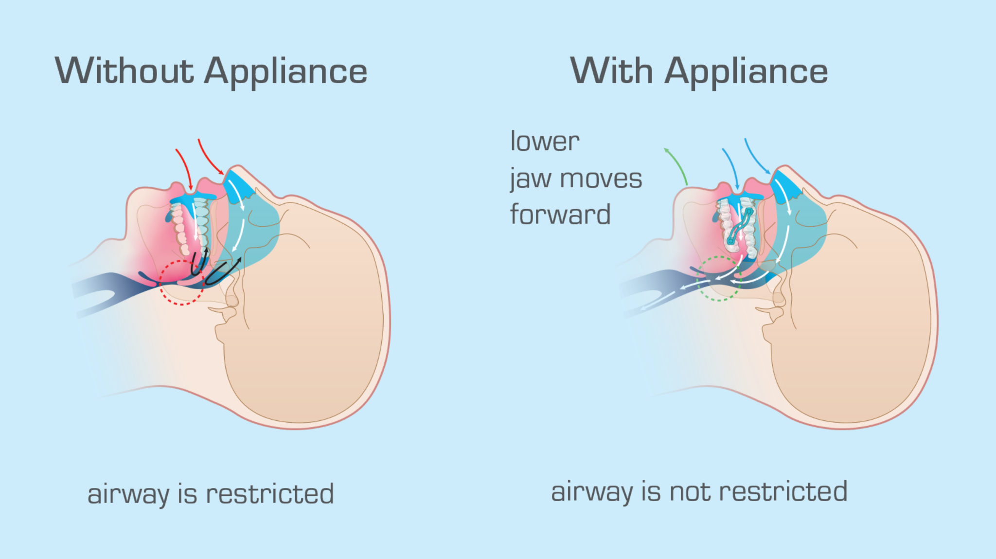 Silent Nite® for Snoring & Sleep Apnea | New West