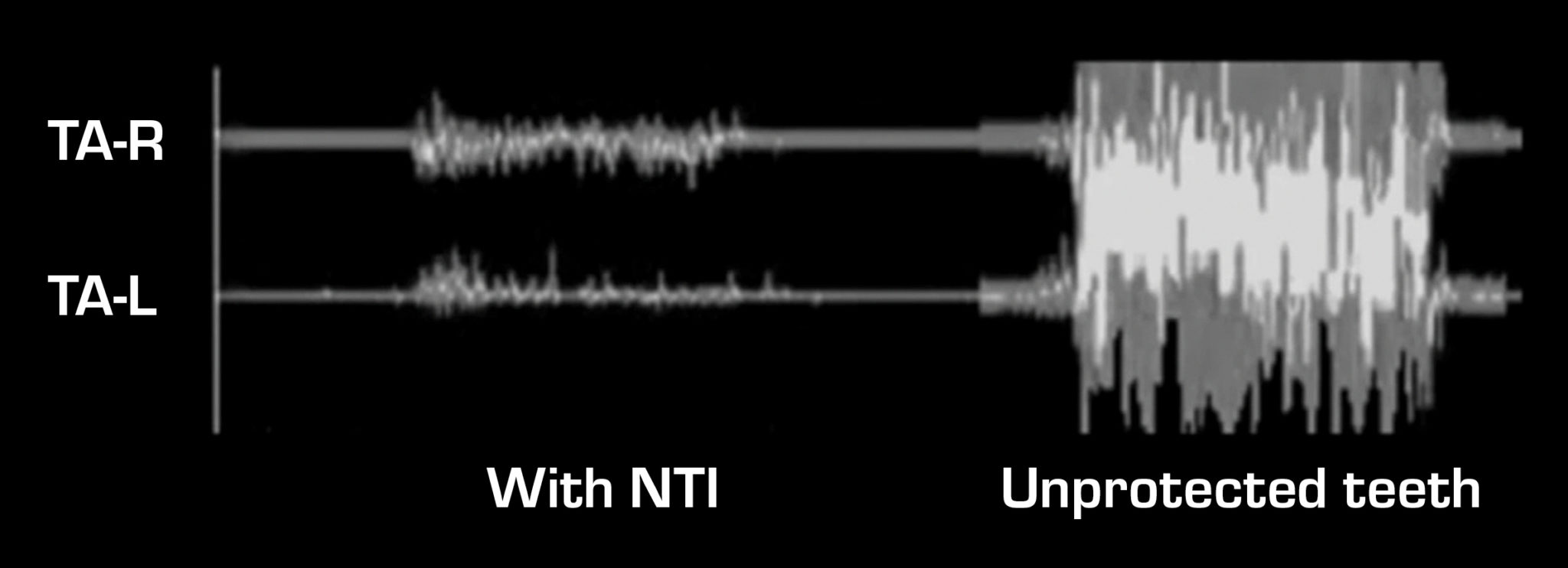 New Study Confirms Efficacy of NTI-tss Plus® Device