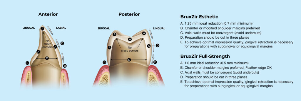 Preferred Esthetic Restorative Material: BruxZir Zirconia or IPS e.max?